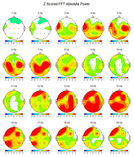 Neurofeedback Branford | QEEG Brain Mapping - Center for NeuroPotential